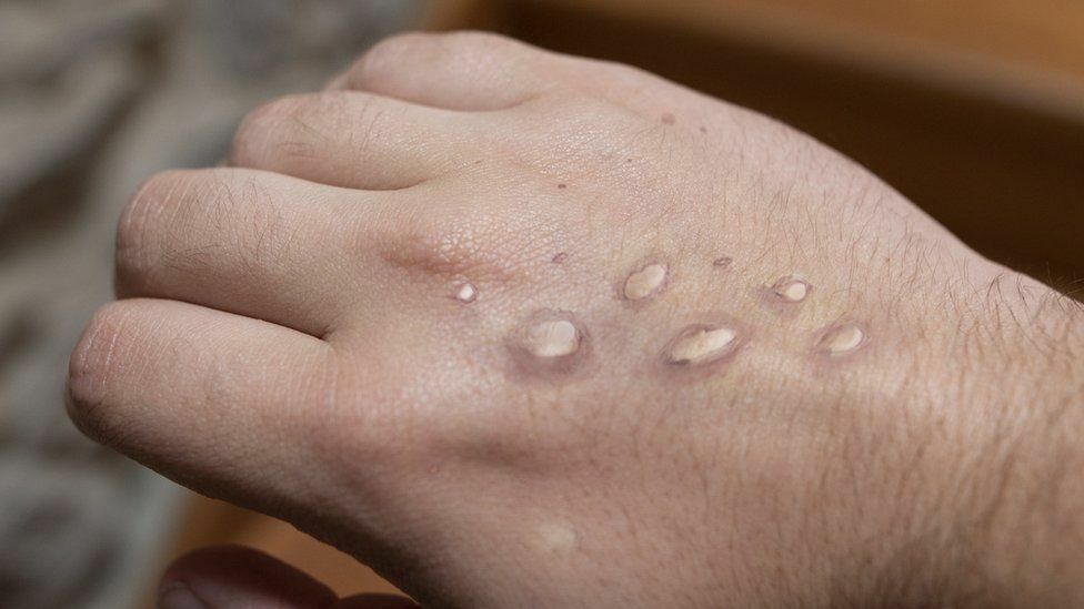 Monkeypox - NHS Shropshire, Telford and Wrekin